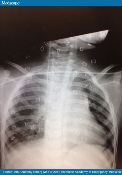 Photo of the Month 1: Metallic Foreign Body on X-ray