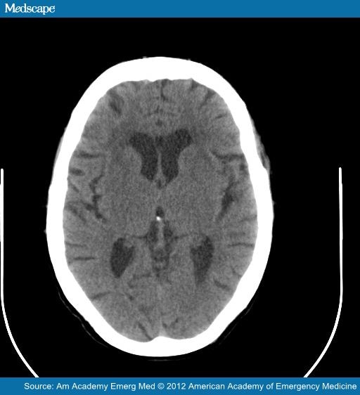 Thunderclap Headache, Negative Head CT