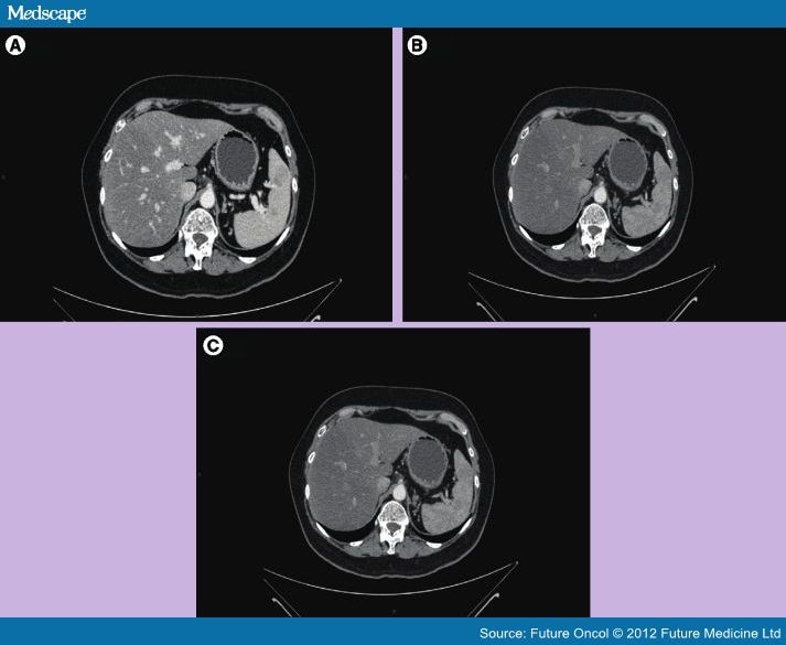 Cytologically Confirmed Splenic Metastases in Breast Cancer - Page 2