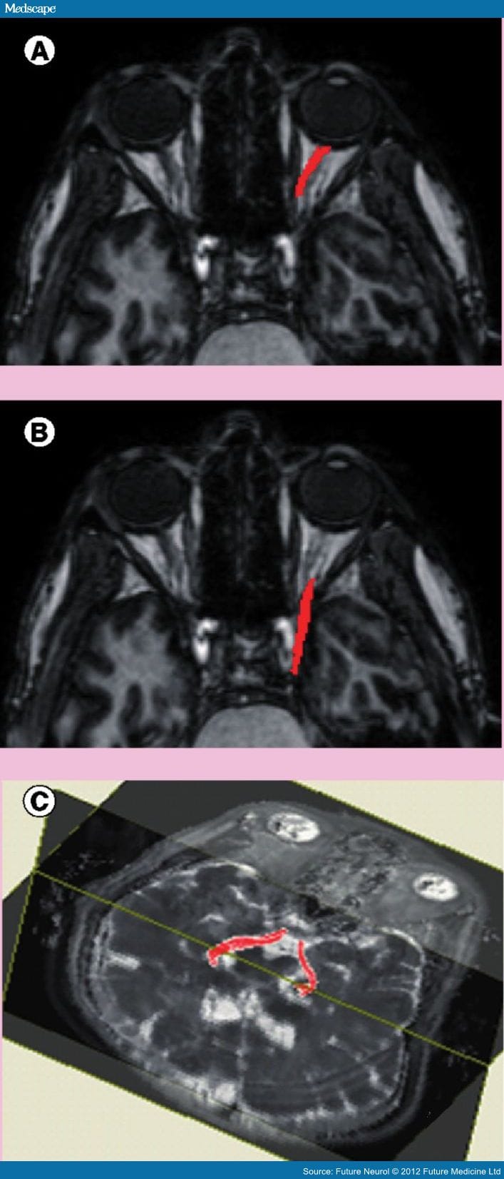 The Neuro-Ophthalmology of Multiple Sclerosis - Page 6