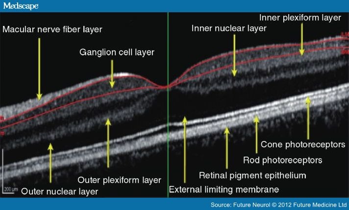 The Neuro-Ophthalmology of Multiple Sclerosis - Page 6