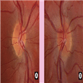 The Neuro-Ophthalmology of Multiple Sclerosis - Page 2