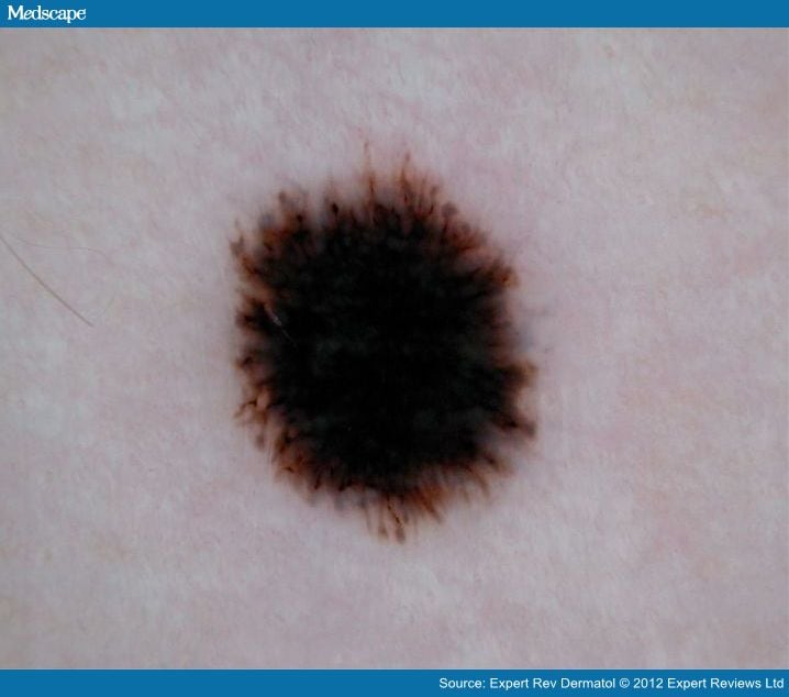 Benign Nevus Vs Melanoma