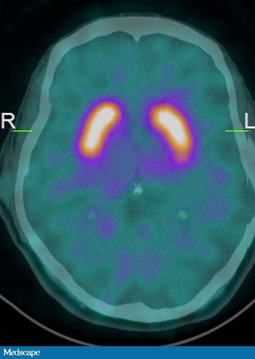 The Role of Dopaminergic Imaging in Patients With Parkinsonism
