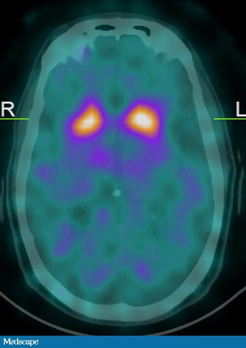 The Role of Dopaminergic Imaging in Patients With Parkinsonism