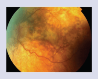 Vogt-Koyanagi-Harada Disease