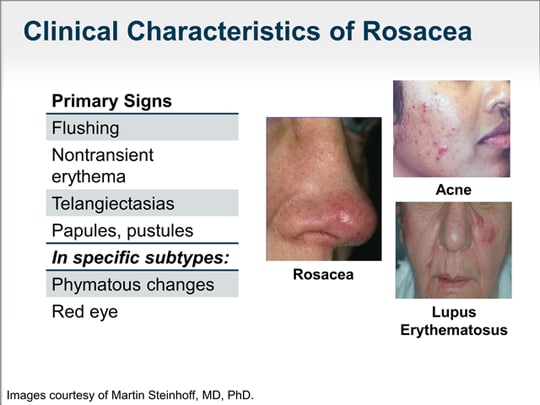 Pathophysiology and Treatment of Erythema in Rosacea (Transcript)