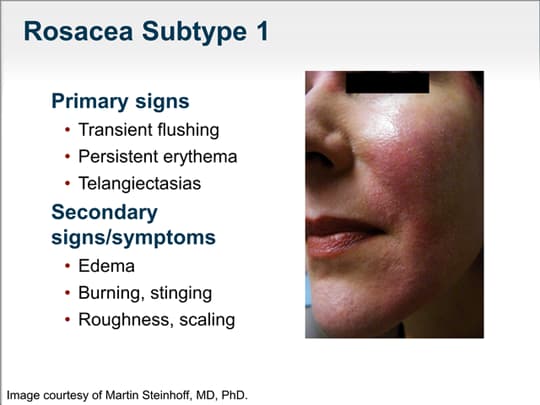 Pathophysiology and Treatment of Erythema in Rosacea (Transcript)