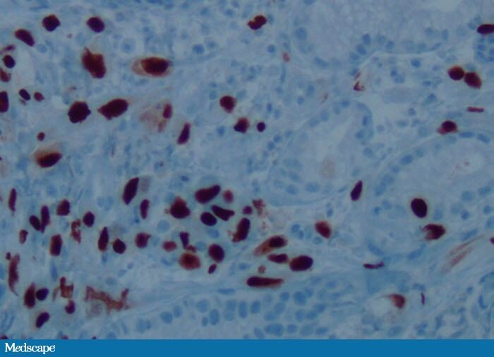 Prevention and Treatment of Cytomegalovirus Infection in Solid Organ ...