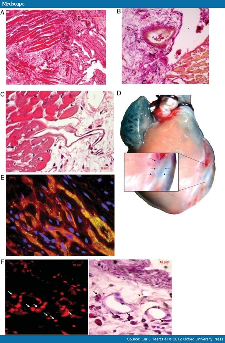 Transplantation of Engineered Heart Tissue in Dilated Cardiomyopathy ...