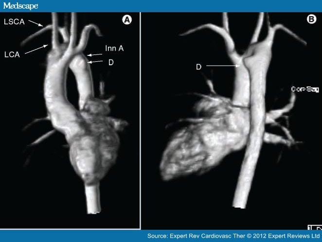 Imaging of Aortic Arch Anomalies and Associated Findings - Page 3