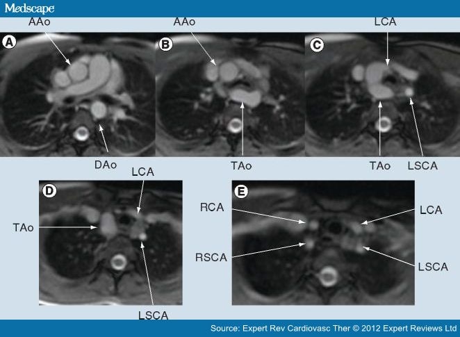 Imaging of Aortic Arch Anomalies and Associated Findings - Page 3