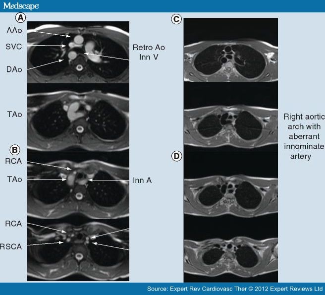 Imaging of Aortic Arch Anomalies and Associated Findings - Page 3