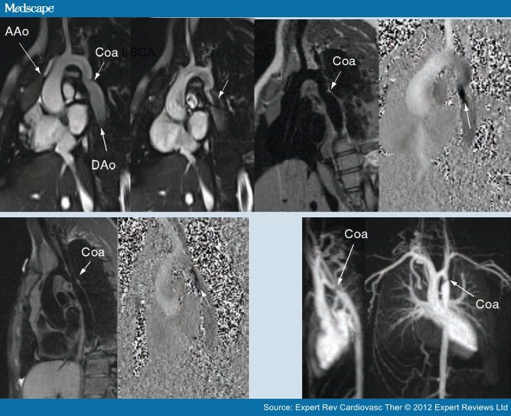 Imaging of Aortic Arch Anomalies and Associated Findings - Page 3