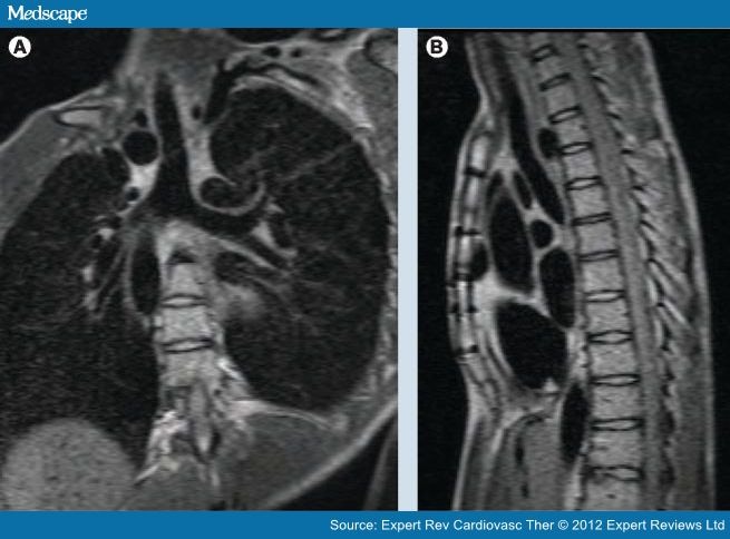 Imaging of Aortic Arch Anomalies and Associated Findings - Page 3
