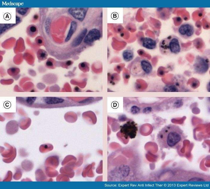 Diagnosing Malaria in Pregnancy - Page 6