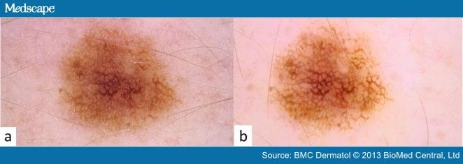 Tips and Tricks in the Dermoscopy of Pigmented Lesions - Page 4