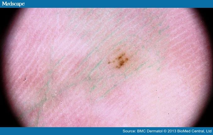 Tips and Tricks in the Dermoscopy of Pigmented Lesions - Page 4