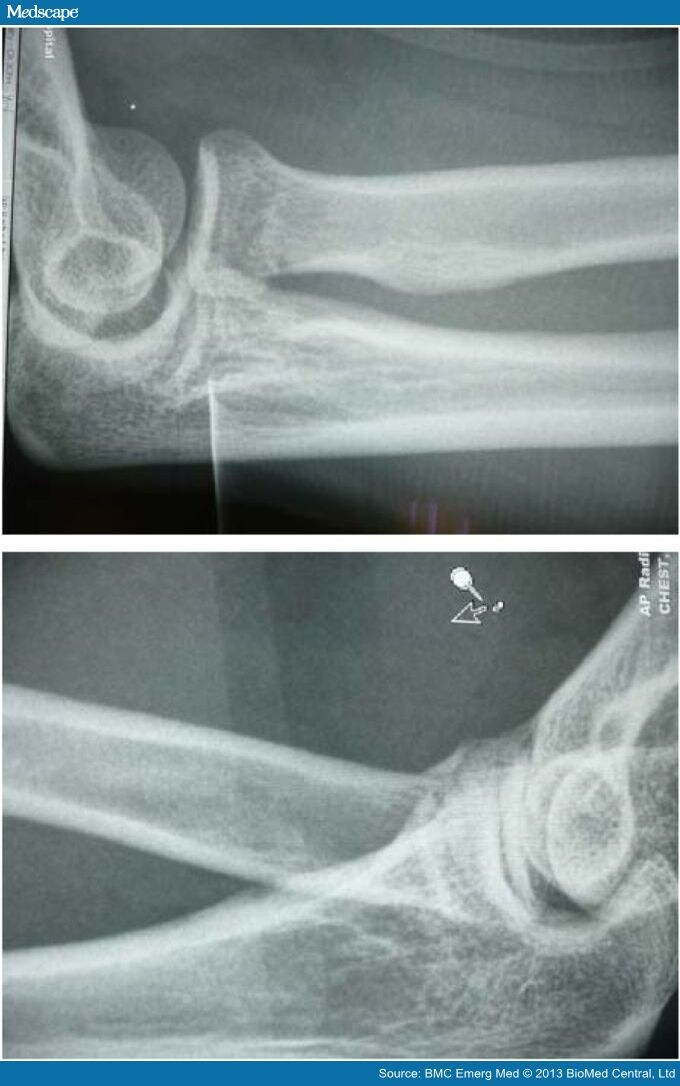 Identical Fracture Patterns in Combat Vehicle Blast Injuries - Page 3