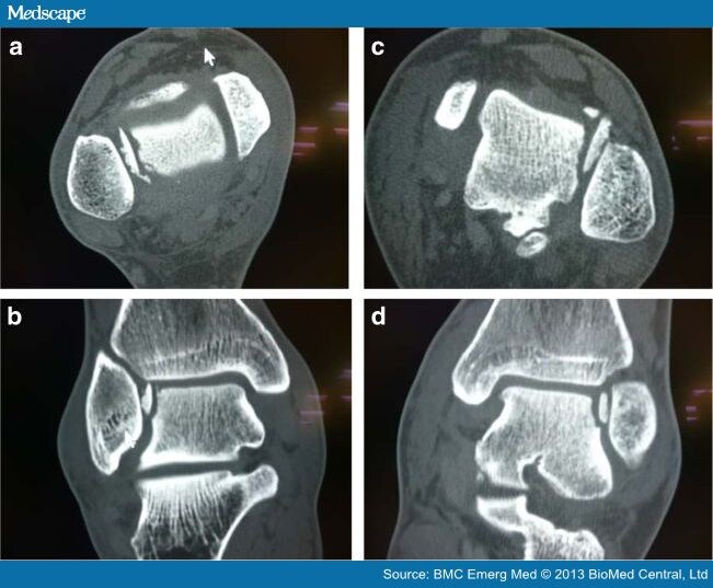 Identical Fracture Patterns in Combat Vehicle Blast Injuries - Page 3