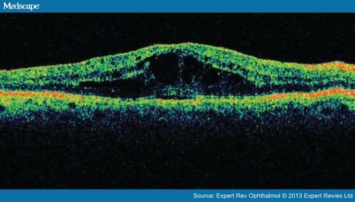 Multiple Sclerosis-associated Uveitis - Page 3