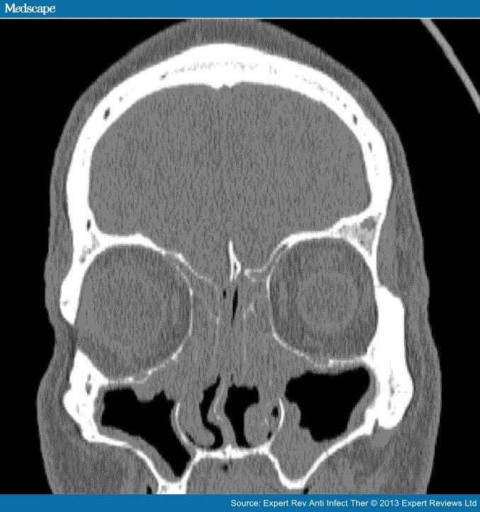 Etiology, Diagnosis and Management of Chronic Rhinosinusitis - Page 3