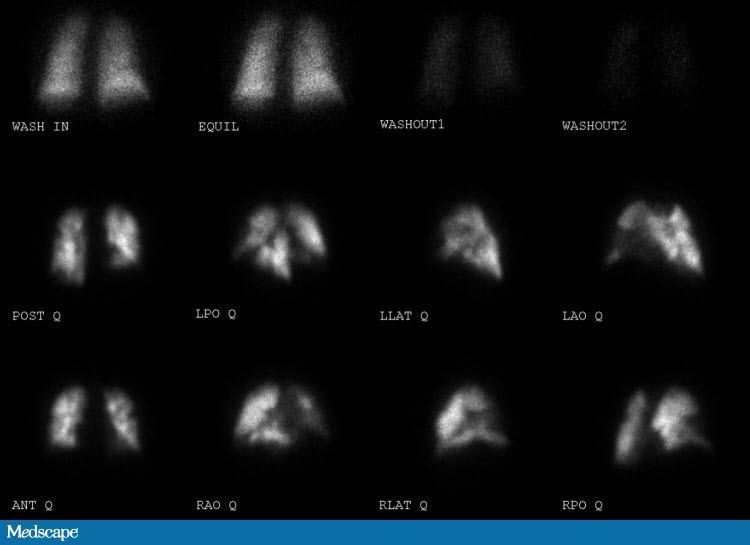 Diagnosis and Management of CTEPH: What Do We Know Today?