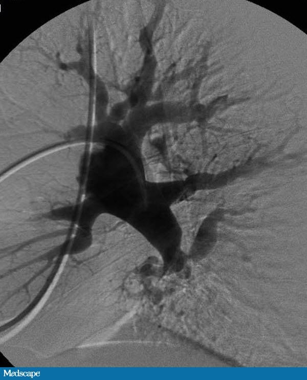 Diagnosis and Management of CTEPH: What Do We Know Today?