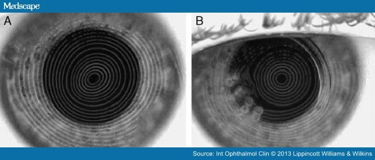 Modern Management of Astigmatism - Page 7