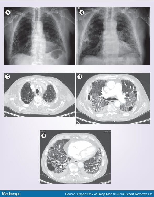 Combined Pulmonary Fibrosis and Emphysema