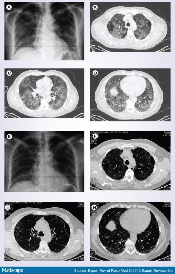 Combined Pulmonary Fibrosis and Emphysema