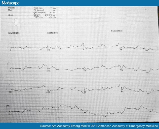 Image of the Month: Critical EKG Findings Not to Miss