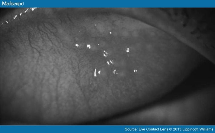 Complications Induced by Silicone Hydrogel Contact Lenses - Page 5