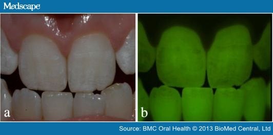 Fluorescent Imaging for Quantification of Dental Fluorosis - Page 3