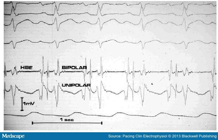 Current Role of Atrioventricular Junction (AVJ) Ablation - Page 4