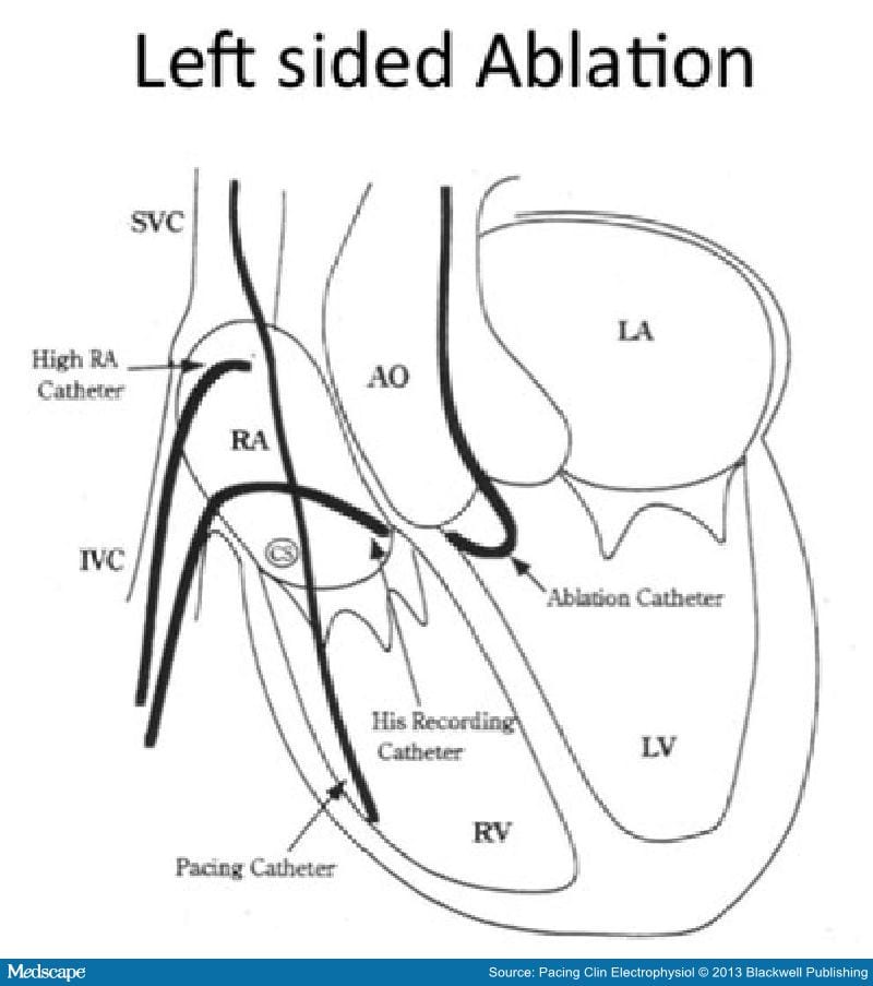 Current Role of Atrioventricular Junction (AVJ) Ablation - Page 5