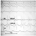 Current Role of Atrioventricular Junction (AVJ) Ablation - Page 4