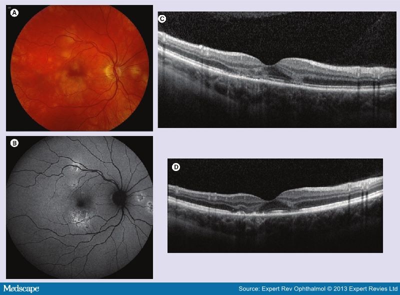 OCT and Fundus Autofluorescence Imaging in Uveitis - Page 5