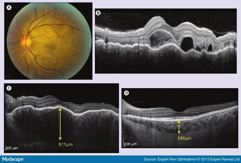 OCT and Fundus Autofluorescence Imaging in Uveitis - Page 10