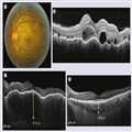 OCT and Fundus Autofluorescence Imaging in Uveitis - Page 10