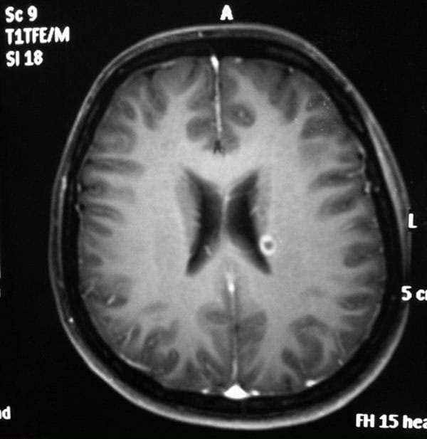 Managing Acute Relapses in Multiple Sclerosis