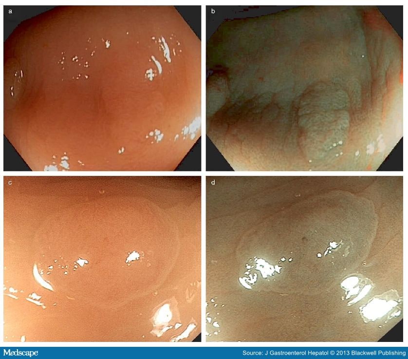Nbi Vs White Light Endoscopy To Assess Colorectal Polyps Page 2