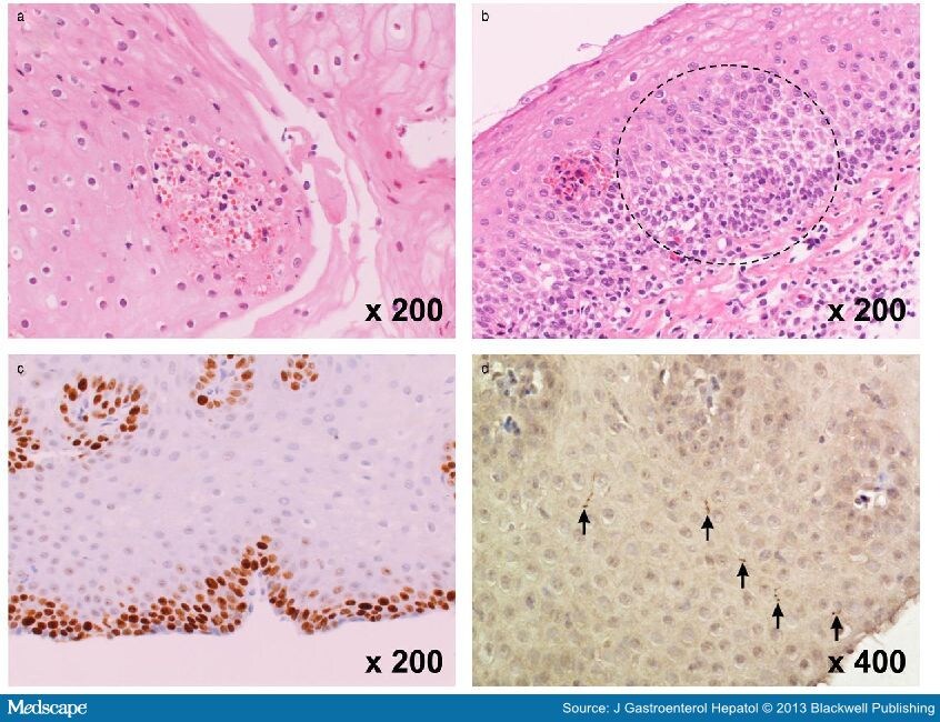 Histology of GERD: Is It Predictive of Response to PPIs? - Page 2