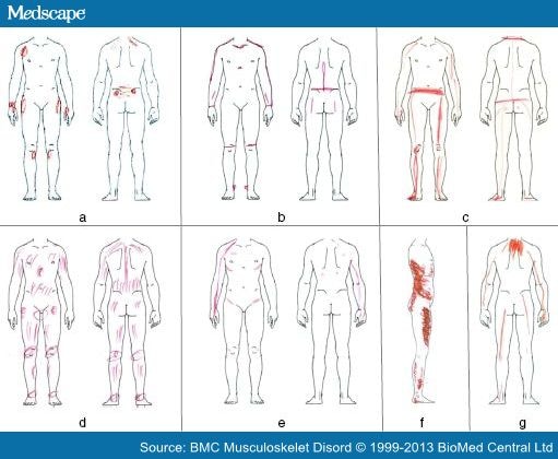 Pain Drawings in Somatoform-Functional Pain - Page 4