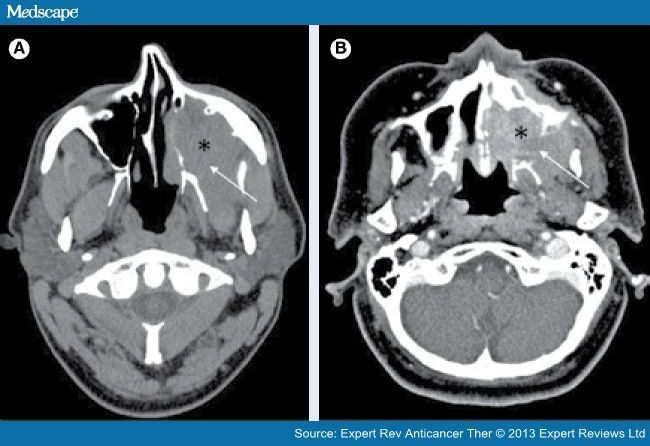 Imaging and Resectability Issues of Sinonasal Tumors - Page 2