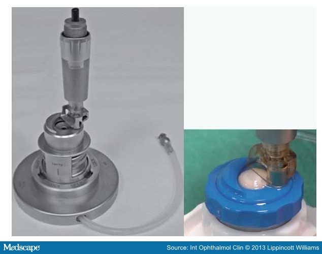 Ultrathin DSAEK - Page 3