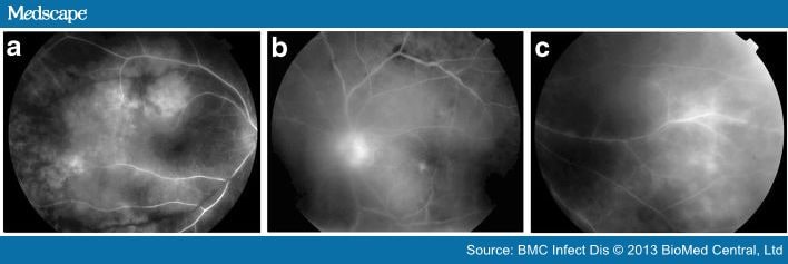 Eyelid Chancre, Syphilis, Chorioretinitis and Uveitis in HIV - Page 2