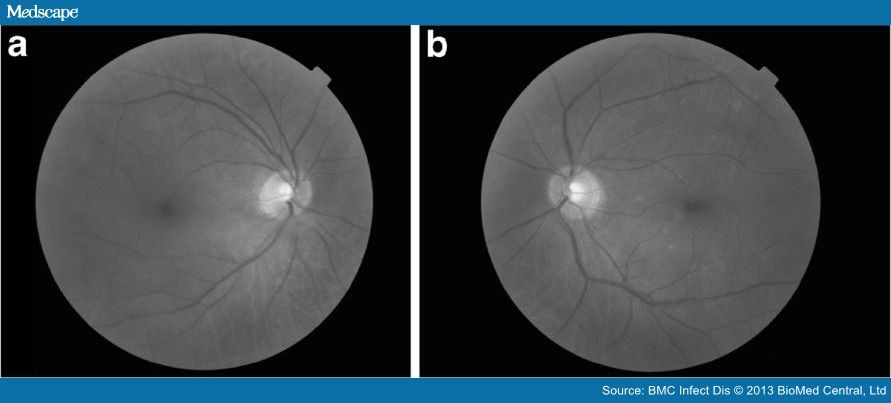 Eyelid Chancre, Syphilis, Chorioretinitis and Uveitis in HIV - Page 2