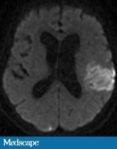 Cryptogenic Stroke: What, When, and How to Treat for Secondary Prevention