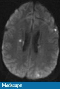 Cryptogenic Stroke: What, When, and How to Treat for Secondary Prevention